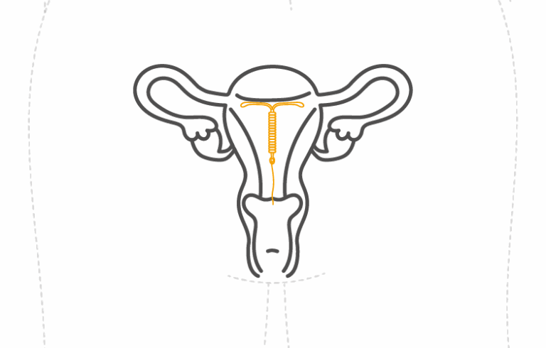 Le DIU au cuivre – MESCONTRACEPTIFS.BE